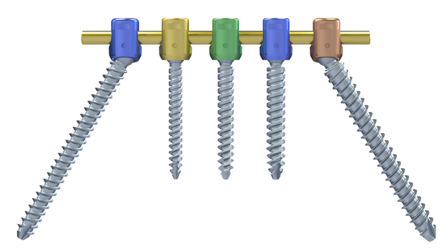 Momentum® - Posterior Spinal Fixation System